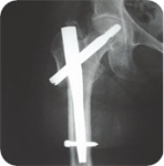 heup ok (heupfractuur, collumfractuur, y-nail, gecanuleerdeschroeven,…